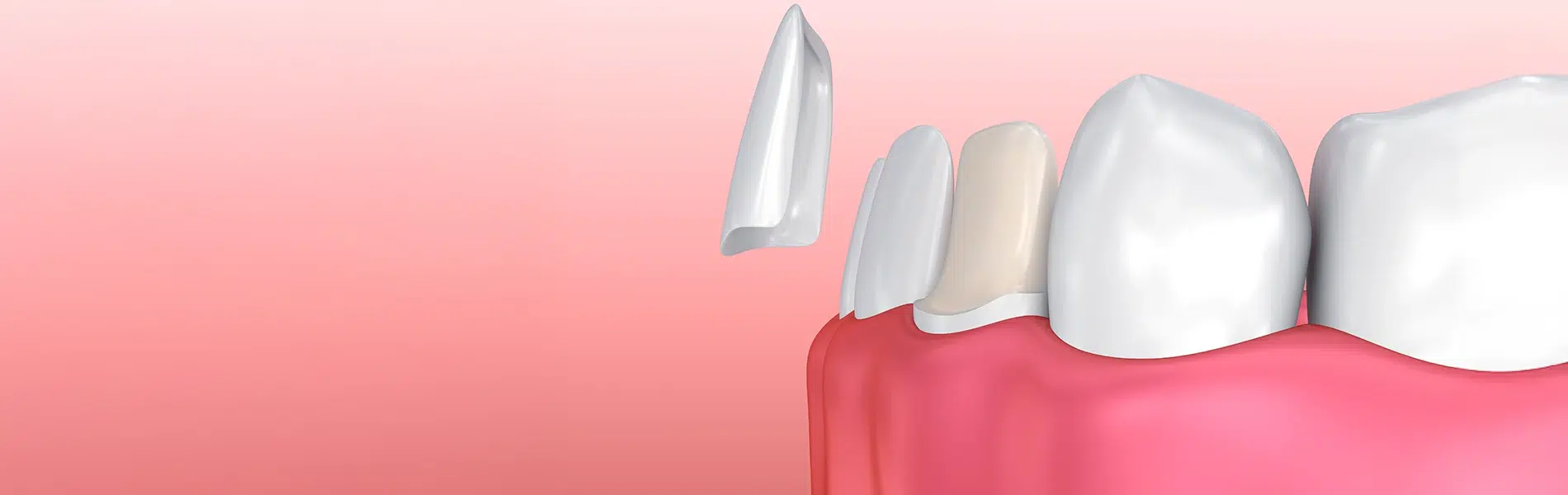 What Happens to Teeth Under Veneers? — Chevy Chase Dental Care